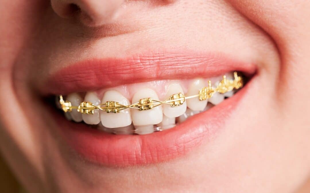 Gold Braces | Grant Orthodontics